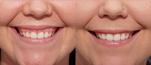 Gummy Smile – MATICLINIC Aesthetics ǀ Anti-Wrinkle Injections ǀ Dermal ...